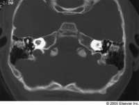 Kathy's MRI Pathology Blog: Labyrinthitis