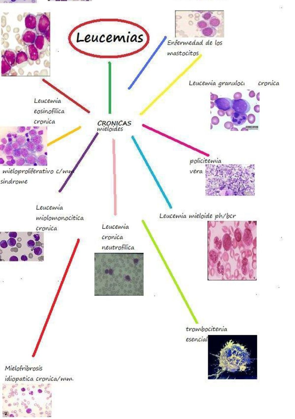 Intervencion En Los Diferentes Tipos De Leucemia Mapas Images Intervencion En Los Diferentes Tipos De Leucemia Mapas Images