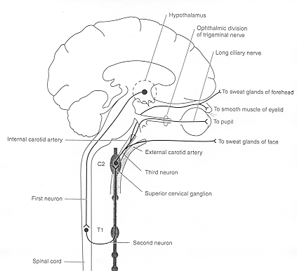 Horner's Syndrome ~ medik-ukm