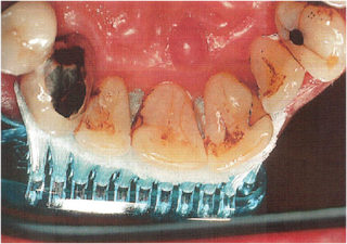 IMU ORAL HEALTH COMMITTEE: IMPORTANCE AND VARIOUS TOOTH BRUSHING TECHNIQUES
