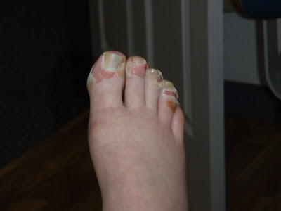 Jill Outside: March 31, 2009 toe update