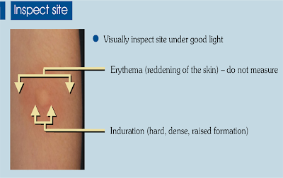 Enfermería: PRUEBA DE LA TUBERCULINA. TÉCNICA DEL MANTOUX