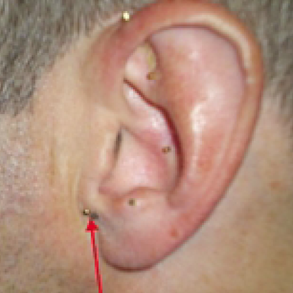 Genomics, Medicine, and Pseudoscience: Battlefield acupuncture ...