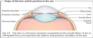 Buzusima Blog: Katarak juvenil