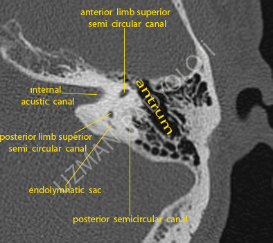 TEMPORAL KEMİK(TEMPORAL BONE) - KAFA TABANI (SKULL BASE) ANATOMİSİ