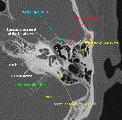 TEMPORAL KEMİK(TEMPORAL BONE) - KAFA TABANI (SKULL BASE) ANATOMİSİ