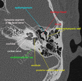 TEMPORAL KEMİK(TEMPORAL BONE) - KAFA TABANI (SKULL BASE) ANATOMİSİ