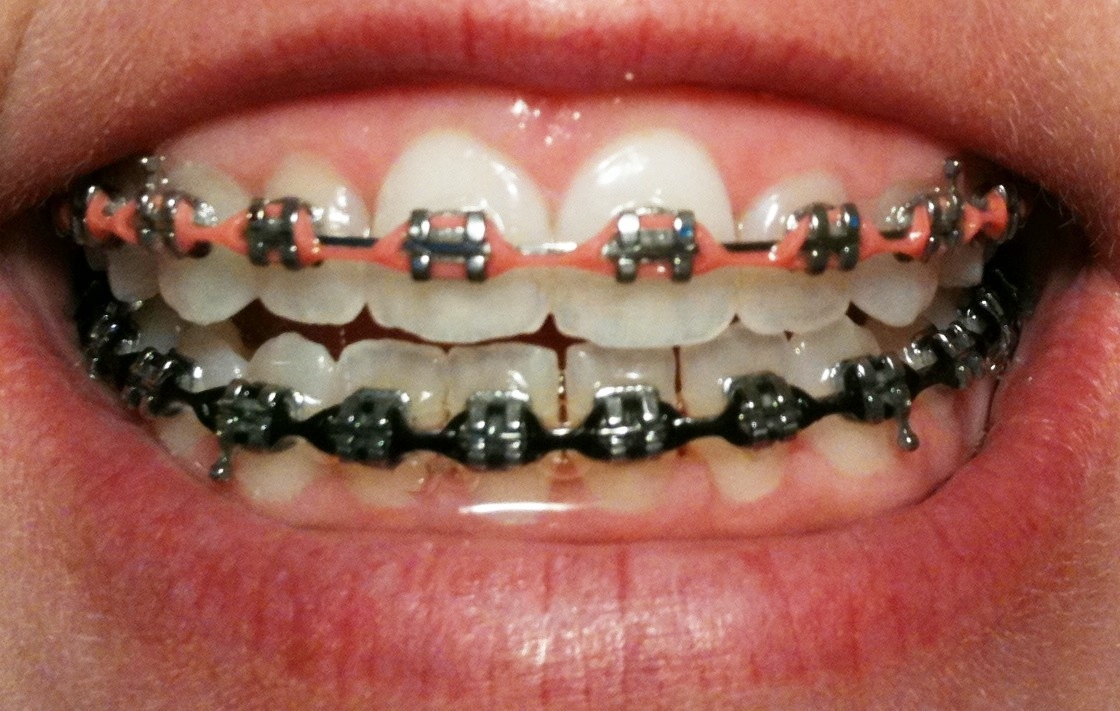 Braces at 37