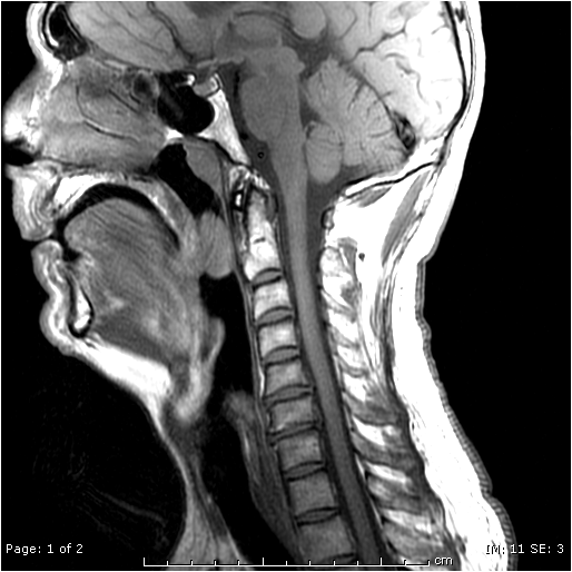 Mindys MRI procedures blog: MRI Trachea Tumor