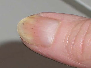 My Non-Hodgkin's Lymphoma Story