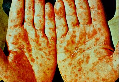 Professora Rochelle: FOTOS SIFÍLIS