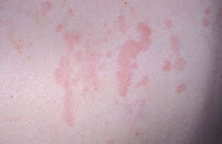 Chronic Urticaria: Cholinergic Urticaria Images Provided by Dermnet.com