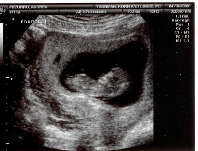 Ready for Round 2: 2nd Sonogram ~ 11 Weeks, 2 Days