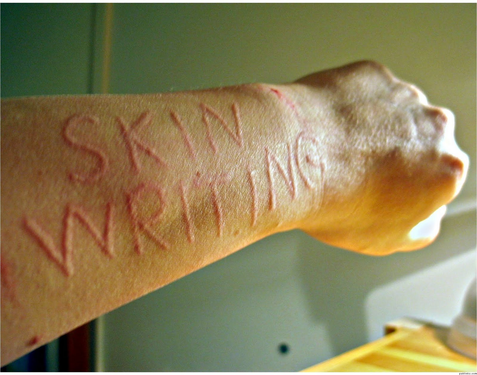 (Thats not my arm btw, just some random google pic)