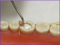 Pediatric Dentistry: IRM Temporary Filling Material