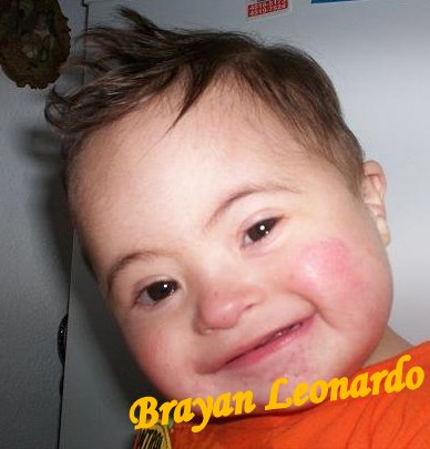 Bebe Recem Nascido Com Sindrome De Down
