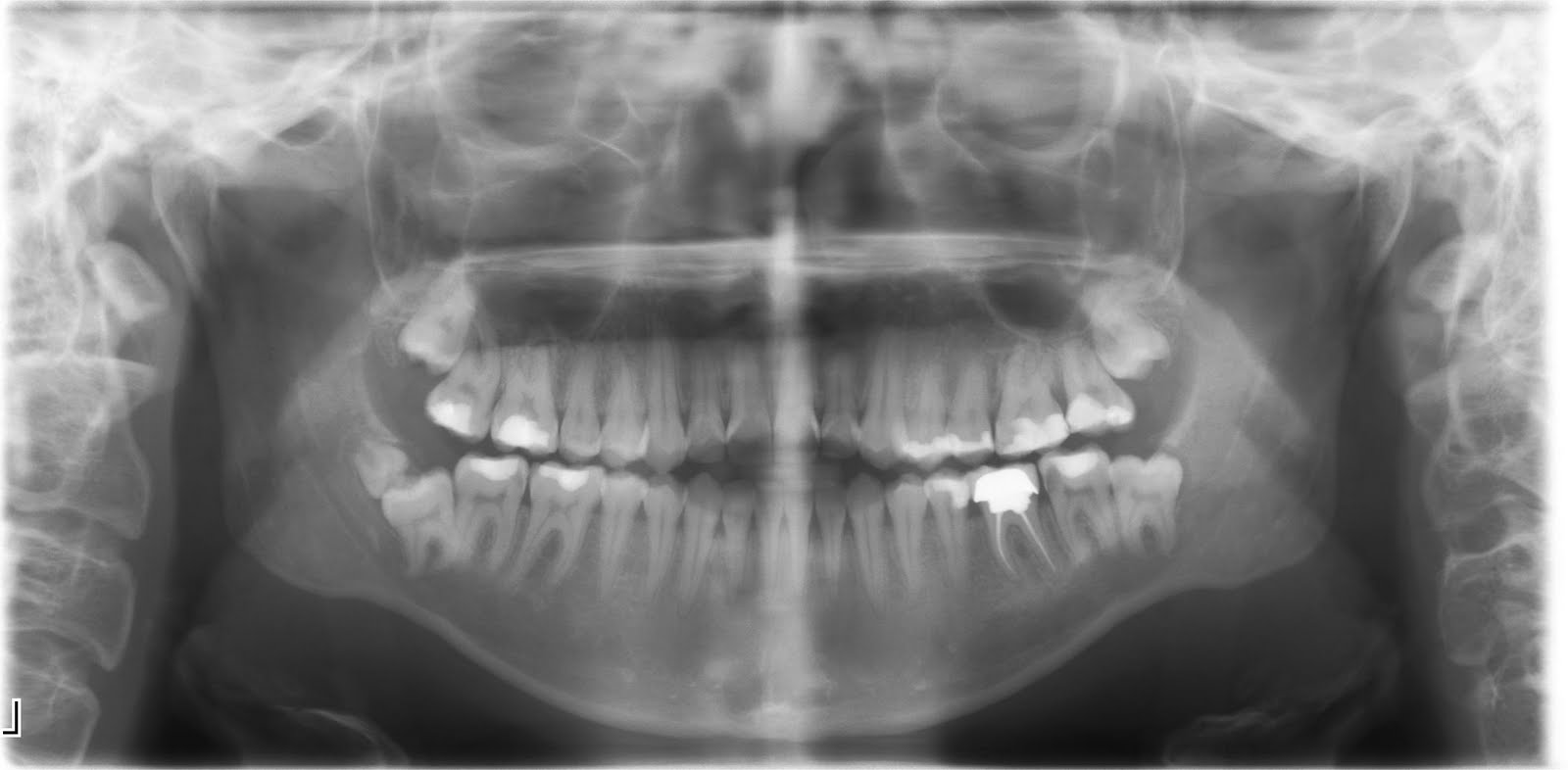 Independence, MO Dentistry: Wisdom Teeth - Why do they have to be removed?