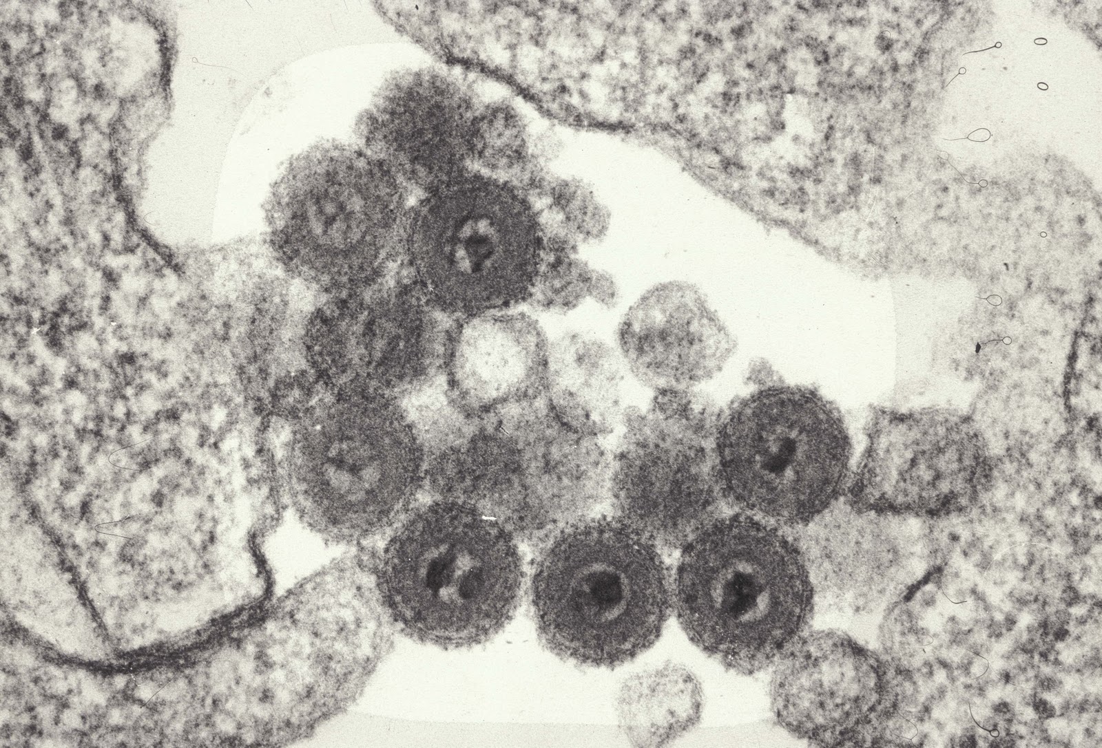 Kami-Ube Pediatric Clinic: Roseola(= Exanthema subitum)