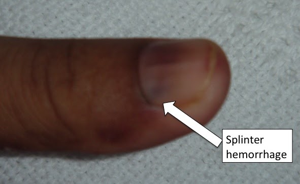 Splinter Hemorrhages Endocarditis