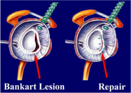 Physio Questions: Shoulder Complex (Part III) - Anterior/Posterior ...