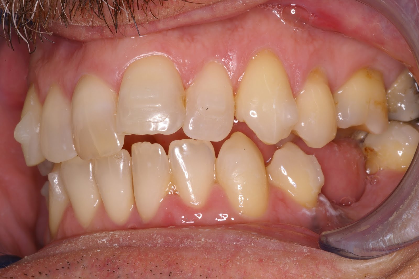 Cosmetic Dentistry and Invisalign: Invisalign first visit