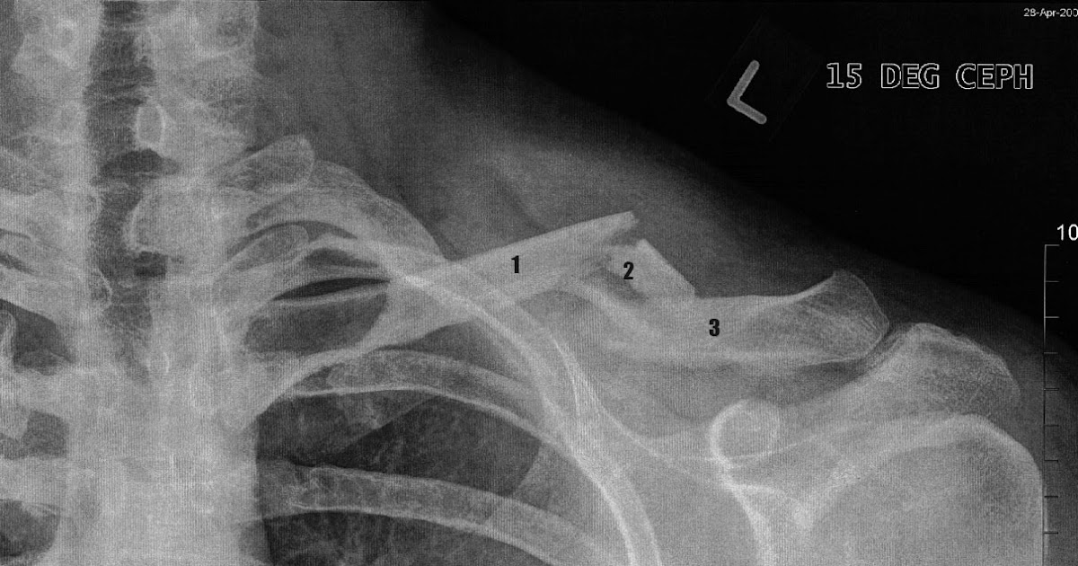 Who Else Wants Info About How To Tell If Your Collar Bone Is Broken ...