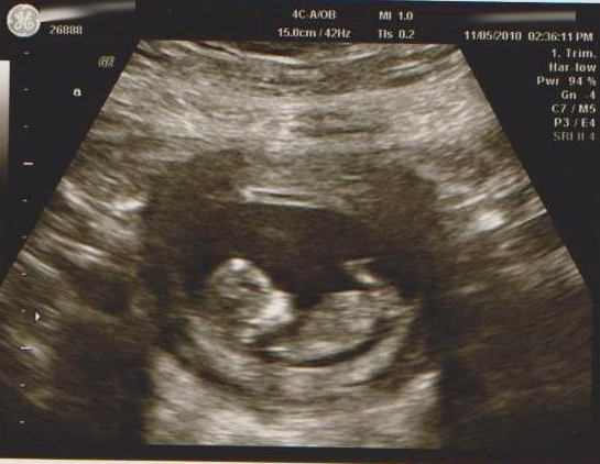 First Time Twins: Ultrasounds - 12 weeks