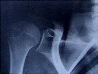 ---RAYOS X 2010--- =): ARTICULACIÓN DEL HOMBRO -PROYECCIÓN OBLICUA A.P ...