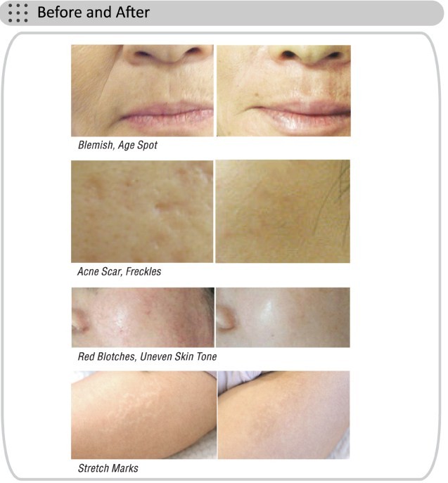 HUMEX,INC.: AMTS-H (Auto Micro Needle Therapy System)