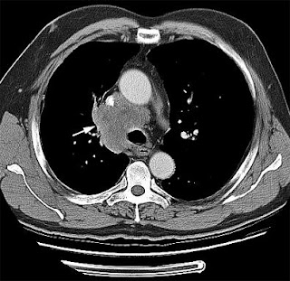 vietshealth: Treatment and prognosis of small-cell lung cancer