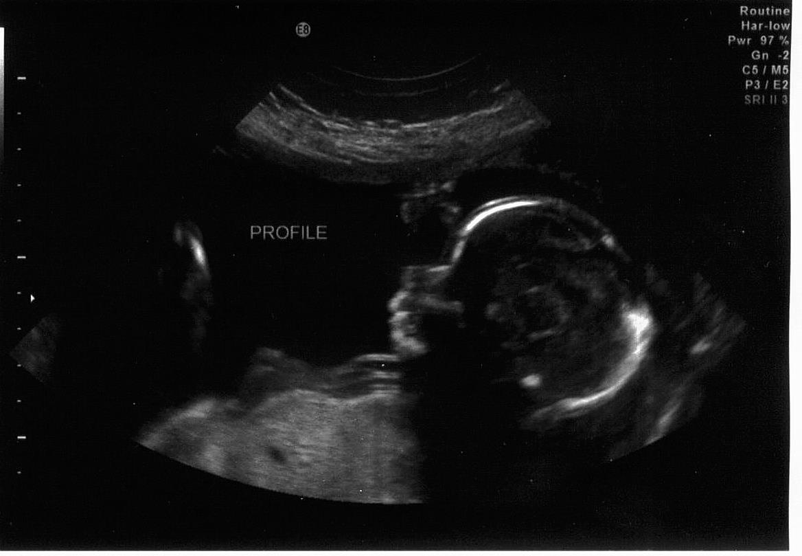 Bert and Kate plus 8: Alien Baby Pictures