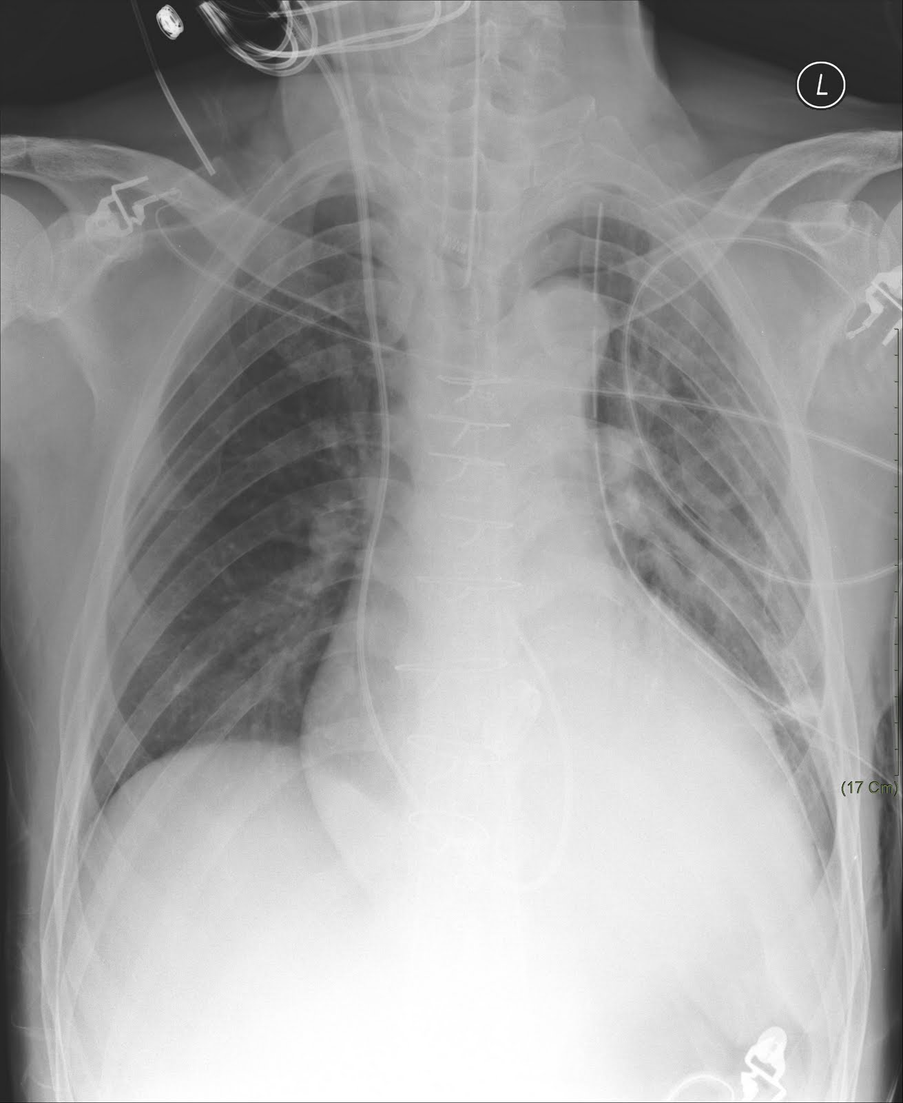 關於外科ICU的一些事: CXR of pneumothorax-2