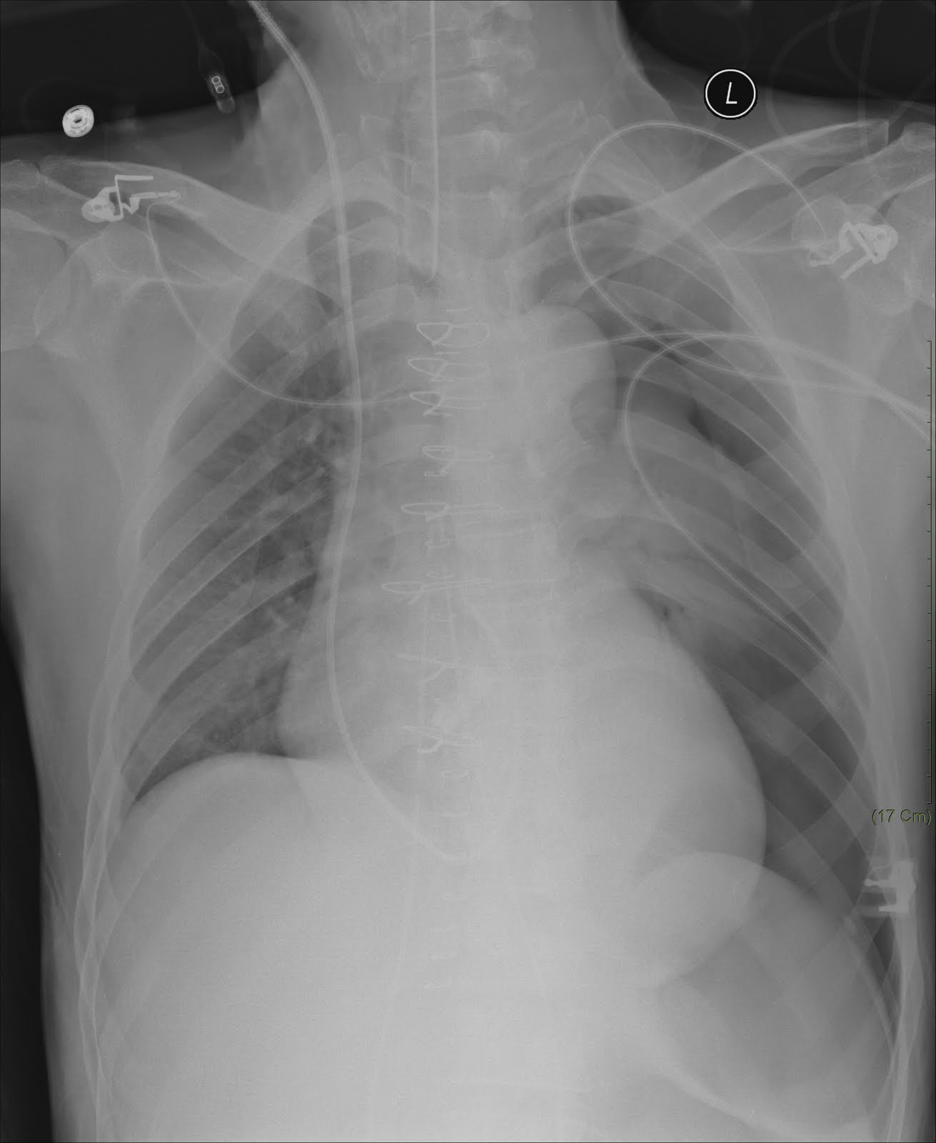 關於外科ICU的一些事: CXR of pneumothorax-2