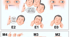 Stroke Notes: Four score is predictor of outcome in coma after cardiac ...