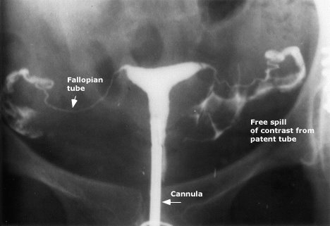 Adventures in Baby Making: HSG??