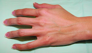 Plastic Surgery / Cosmetic Surgery: Make Your Hands Look Younger!