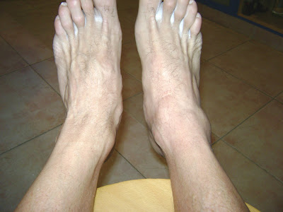 elgym: ESGUINCE, SINOVITIS O BURSITIS DE TOBILLO