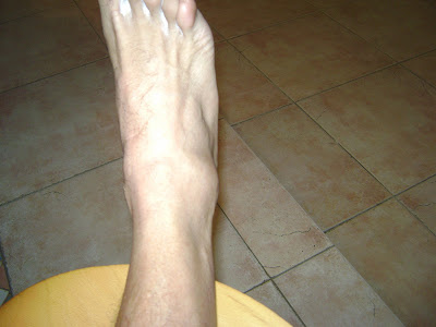 elgym: ESGUINCE, SINOVITIS O BURSITIS DE TOBILLO