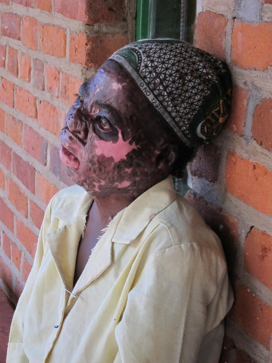 Living Africa Burn Relief Staring Into The Face Of Epilepsy And Burns
