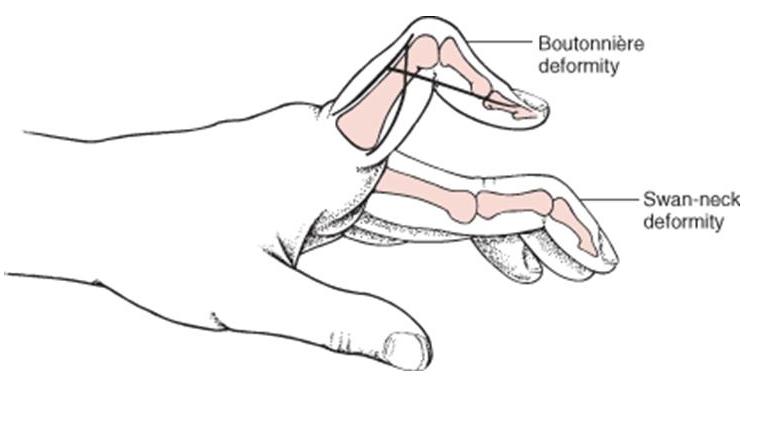 The Pulse: Rheumatoid Arthritis: Some hand findings