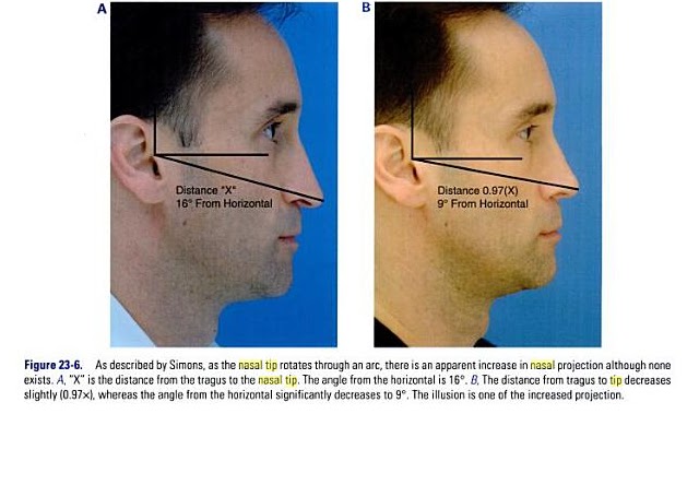 Nose Revision Surgery and Surgeons: The Nose Tip: Dimensional Analysis 101