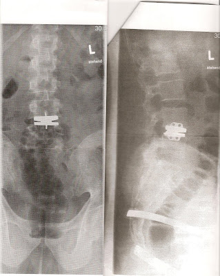 Artificial disc replacement