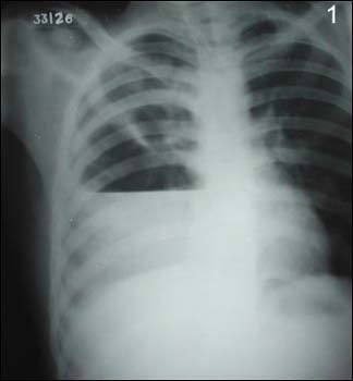 PRUEBAMODULO 2: EMPIEMA