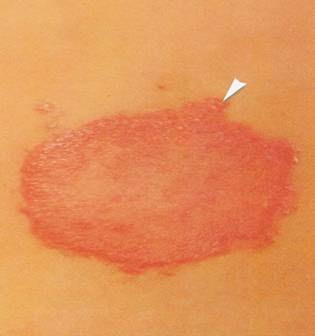 Projeto APE - D.E Jaú: HANSENÍASE