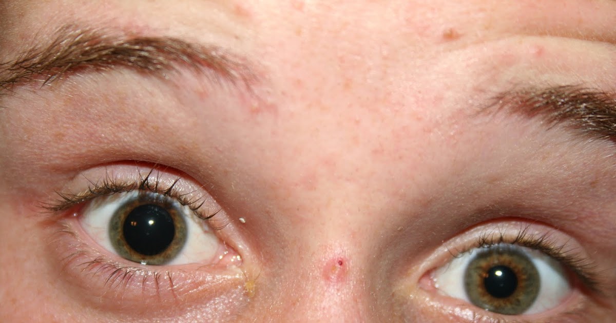 the follett family: Nick's newest injury! HYPHEMA