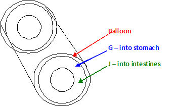 Wendy's Journey - A Double Lung Transplant: Feeding Tubes and ER visit