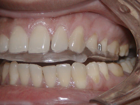 Ask Dr. Doug: What the Heck Are Night Guards?