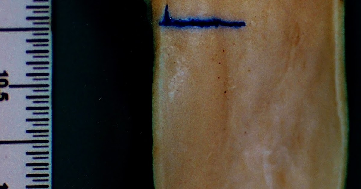 HISTOPATOLOGIA FORENSE PRACTICA (FORENSIC PATHOLOGY FORUM): 6.-SIGNS IN ...