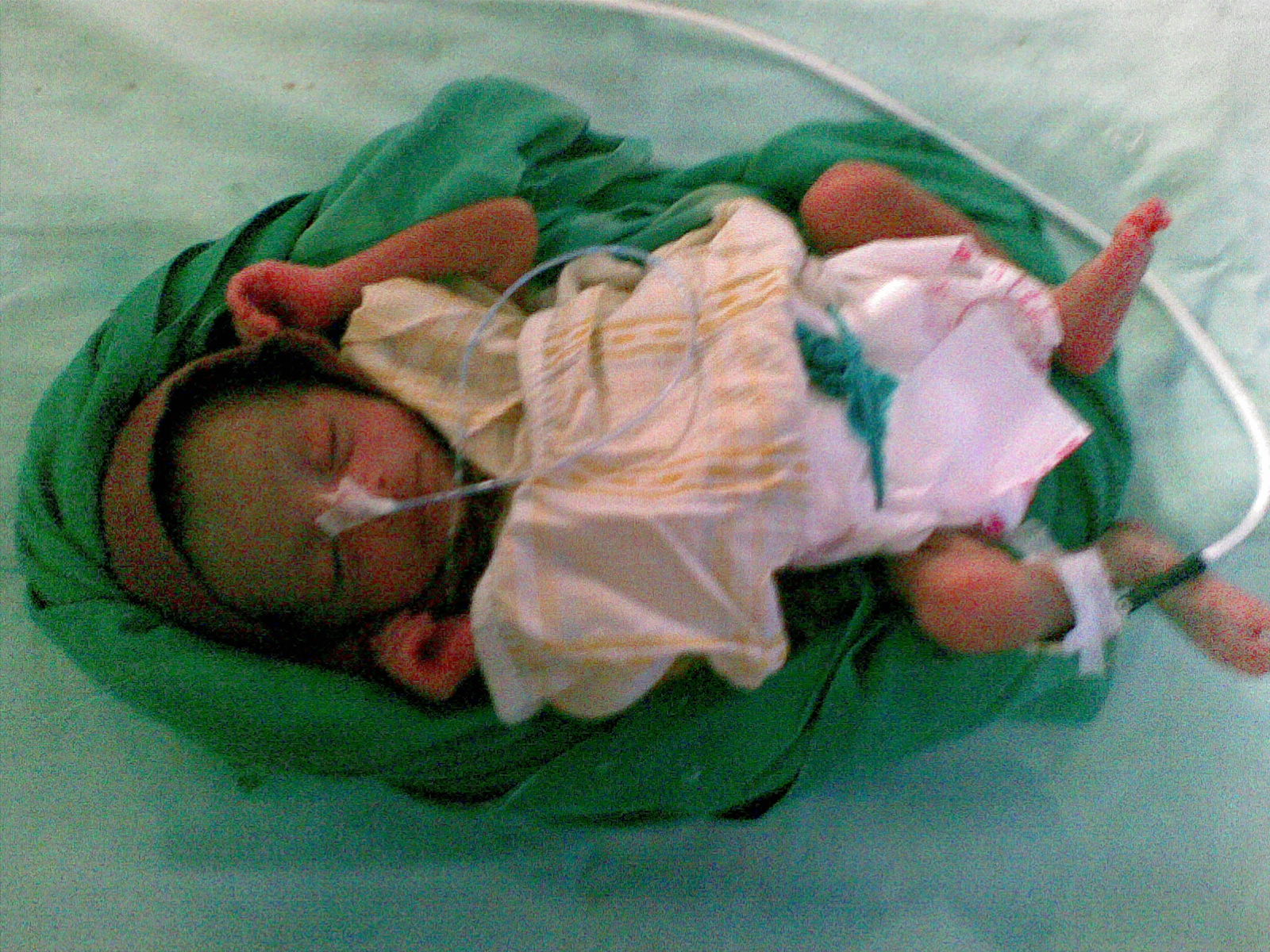 Neo Clinic: Nesting of newborn