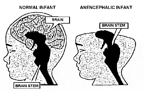 Bebê Anencéfalo / Anencephaly baby: Sofia e seus 123 dias